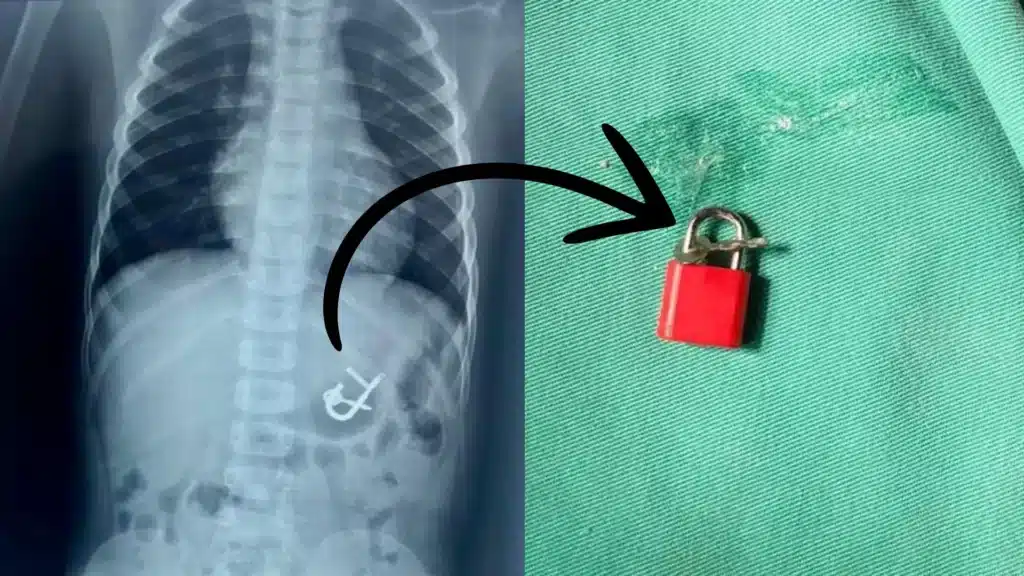 Menino de 4 anos engole cadeado com chaves é salvo por procedimento de ...